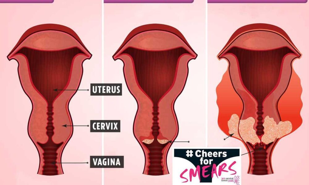Cervical Cancer: The Silent Killer- Understanding the Disease and Its ... Cervical Cancer: The Silent Killer- Understanding the Disease and Its ...